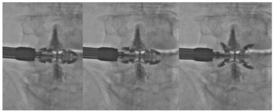 Percutaneous Interspinous Spacer in Spinal-Canal-Stenosis Treatment ...