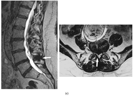 Percutaneous Interspinous Spacer in Spinal-Canal-Stenosis Treatment ...