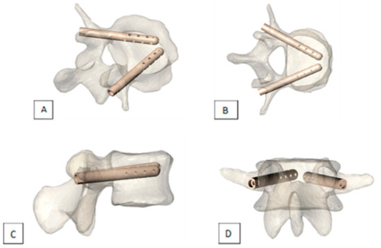 Innovative Spine Implants for Improved Augmentation and Stability in ...