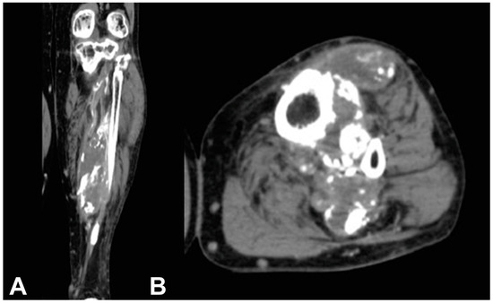 Calcific Myonecrosis of the Leg: A Rare Entity