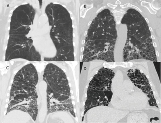 Combined Pulmonary Fibrosis and Emphysema: Pulmonary Function Testing ...