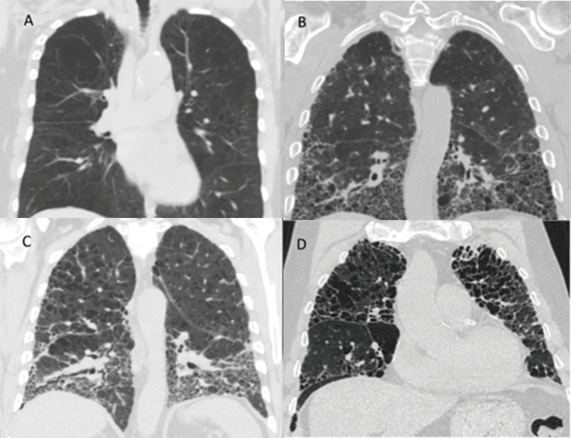 Medicina Free Full Text Combined Pulmonary Fibrosis And Emphysema