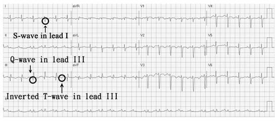 Pulmonary Embolism and Severe Asthma: Case Report and Literature Review