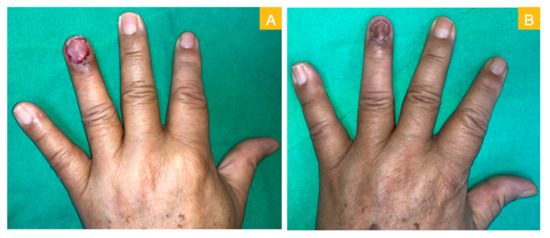 Reconstruction for Defects of Total Nail Bed and Germinal Matrix Loss ...