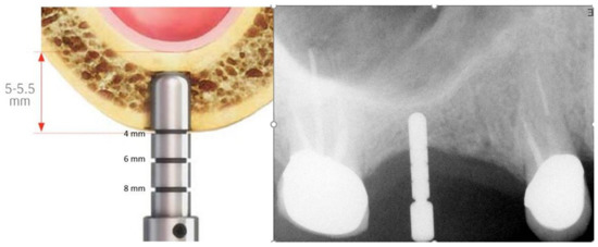 Sinus Augmentation with Simultaneous, Non-Submerged, Implant Placement ...