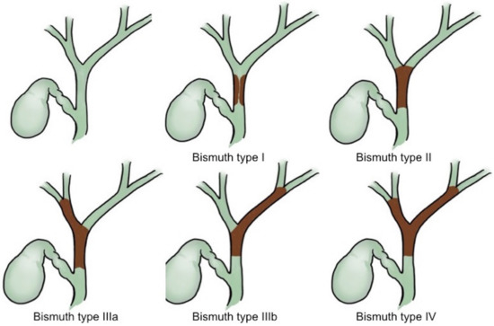 Current Endoscopic Management of Malignant Biliary Stricture