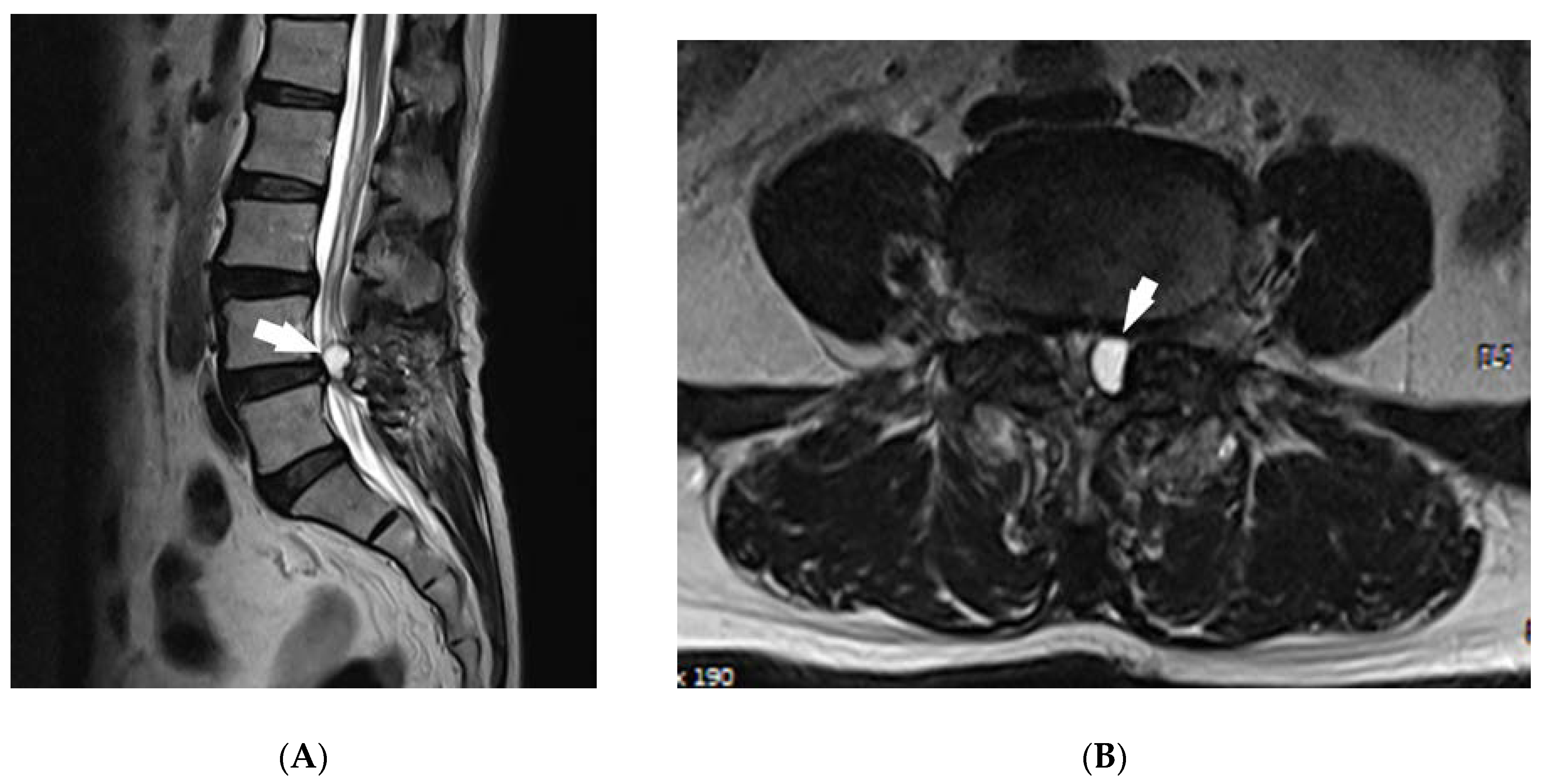 Medicina Free Full Text Transforaminal Epiduroscopic Laser Ablation For Removal Of A