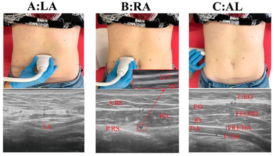 Effects of Cesarean Section and Vaginal Delivery on Abdominal Muscles ...