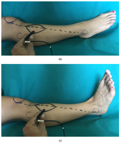 The Effect of Muscle Exercise on Perforators Flow: A Prospective Cohort ...