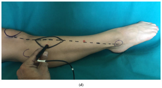 The Effect of Muscle Exercise on Perforators Flow: A Prospective Cohort ...