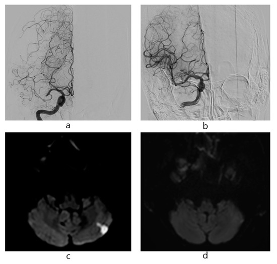 Factors Associated with Procedural Thromboembolisms after Mechanical ...