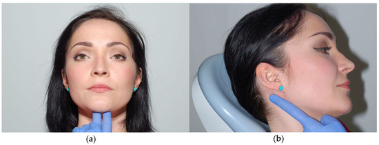 Diagnostic of Temporomandibular Disorders and Other Facial Pain ...