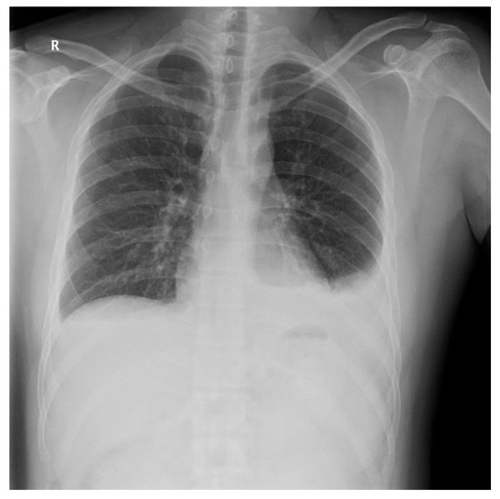 Postoperative Chylothorax after Modified Radical Neck Dissection for ...