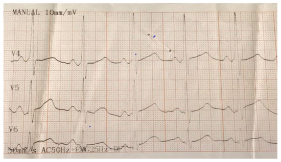 Paroxysmal Supraventricular Tachycardia in Wolff–Parkinson–White ...