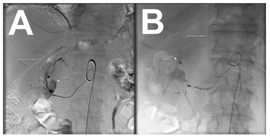 Successful Embolization of Posterior Inferior Pancreaticoduodenal ...