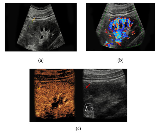 Diagnostic Performance of Contrast-Enhanced Ultrasound (CEUS) in the ...