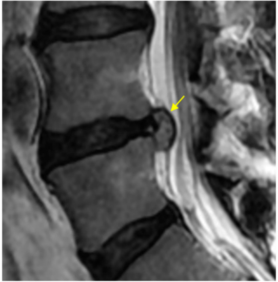Chemonucleolysis with Chondroitin Sulfate ABC Endolyase for Treating ...