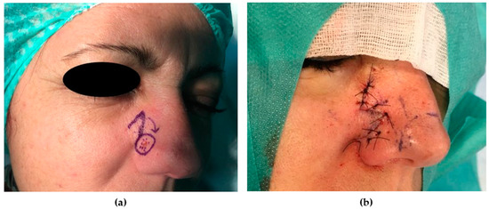 Reconstruction of the Nose: Management of Nasal Cutaneous Defects ...