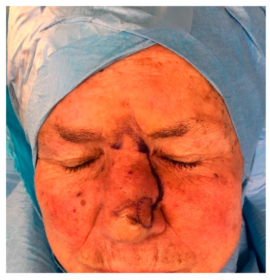 Reconstruction of the Nose: Management of Nasal Cutaneous Defects ...