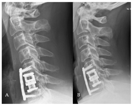 Application of an Expandable Cage for Reconstruction of the Cervical ...
