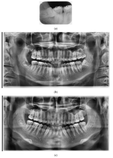 Coronectomy of Mandibular Third Molar: Four Years of Follow-Up of 130 Cases