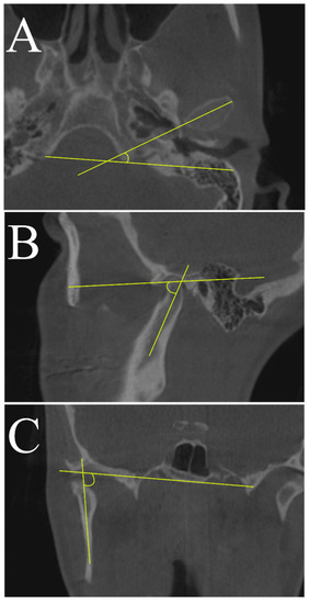 Medicina | Free Full-Text | Evaluation of Condylar Positional ...