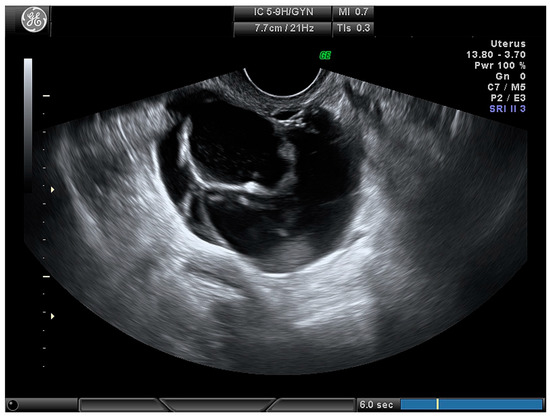 Performance of the IOTA ADNEX Model on Selected Group of Patients with ...
