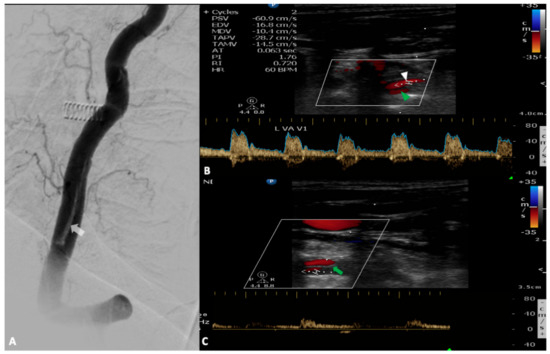Ultrasound Assessment of Extracranial Carotids and Vertebral Arteries ...