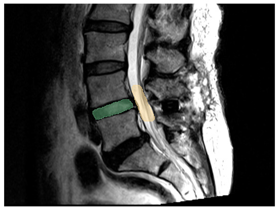 Three-Dimensional Volumetric Changes and Clinical Outcomes after ...