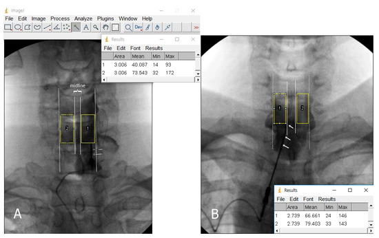 Evaluation of Contrast Flow Patterns with Cervical Interlaminar ...