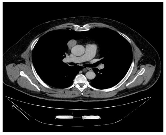Correlation of Computed Tomography Parameters with Histology, Stage and ...