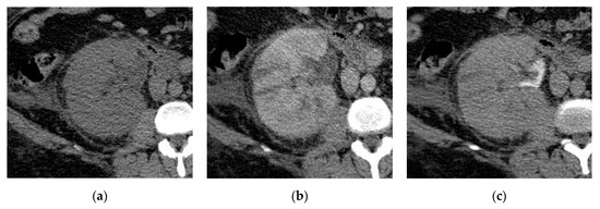 Medicina | Free Full-Text | CT and MRI in Urinary Tract Infections: A ...