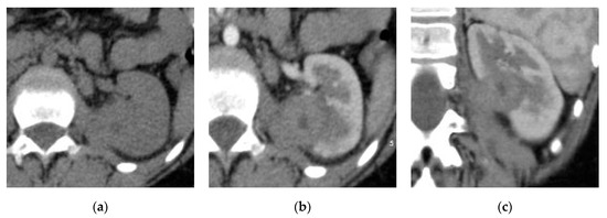 CT and MRI in Urinary Tract Infections: A Spectrum of Different Imaging ...