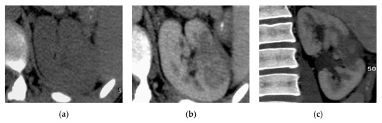 Medicina | Free Full-Text | CT and MRI in Urinary Tract Infections: A ...