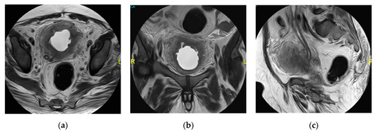 CT and MRI in Urinary Tract Infections: A Spectrum of Different Imaging ...