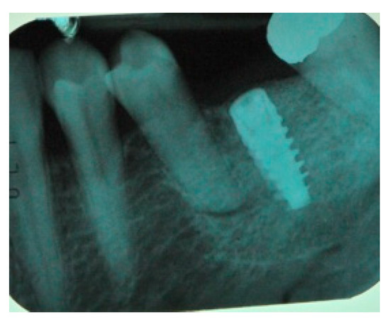 Digital Customized Titanium Mesh for Bone Regeneration of Vertical ...