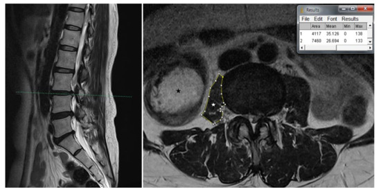 Severe Atrophy of the Ipsilateral Psoas Muscle Associated with Hip ...
