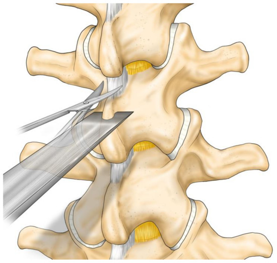 Partial Resection of Spinous Process for the Elderly Patients with ...