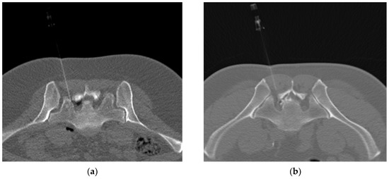 Comparison of Pulsed Radiofrequency, Oxygen-Ozone Therapy and Epidural ...