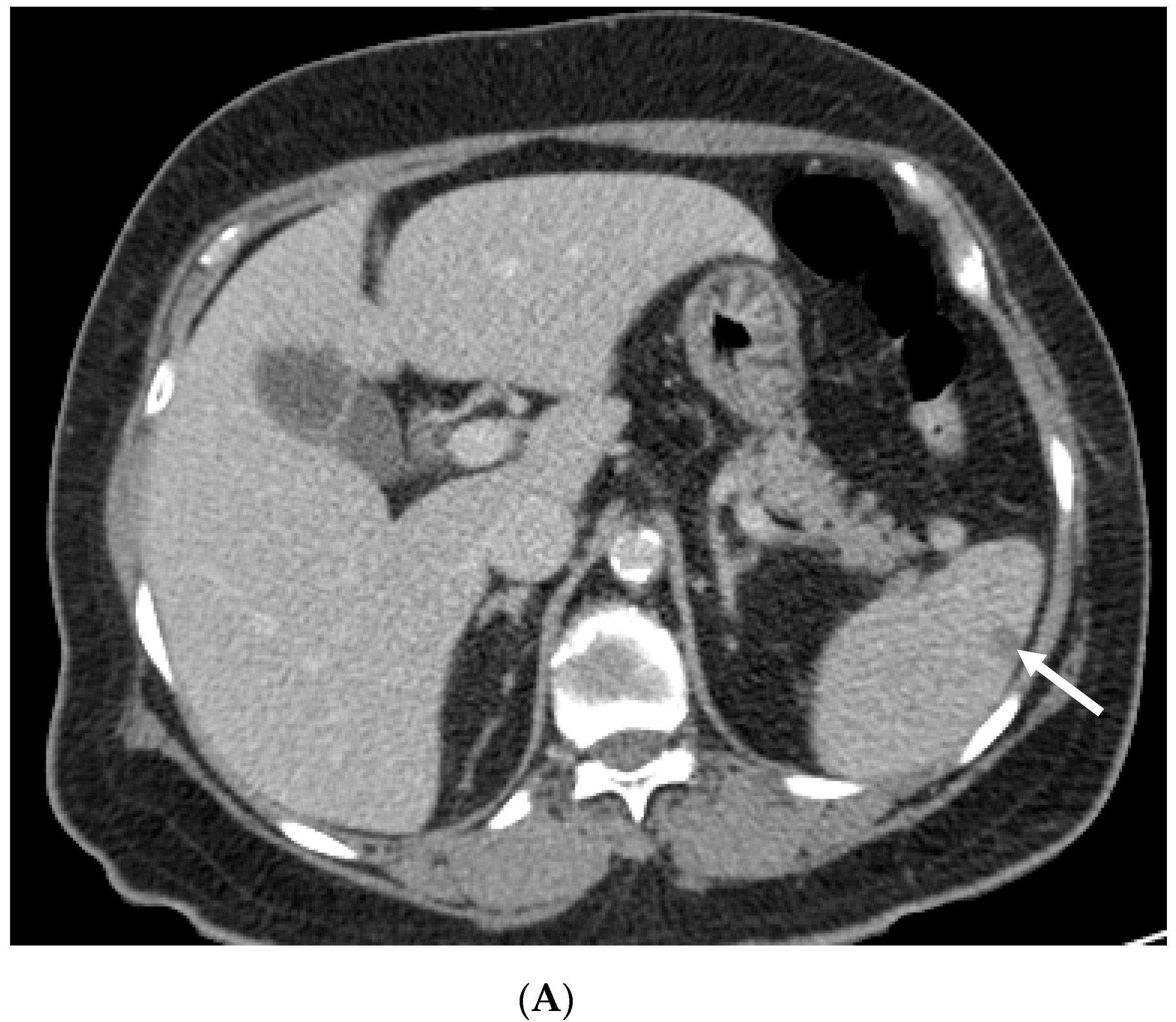 Microscopic Polyangiitis Presenting with Splenic Infarction: A Case Report