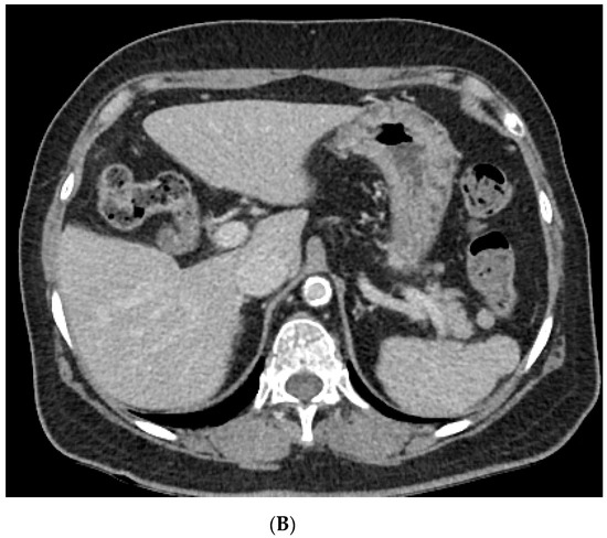 Microscopic Polyangiitis Presenting with Splenic Infarction: A Case Report
