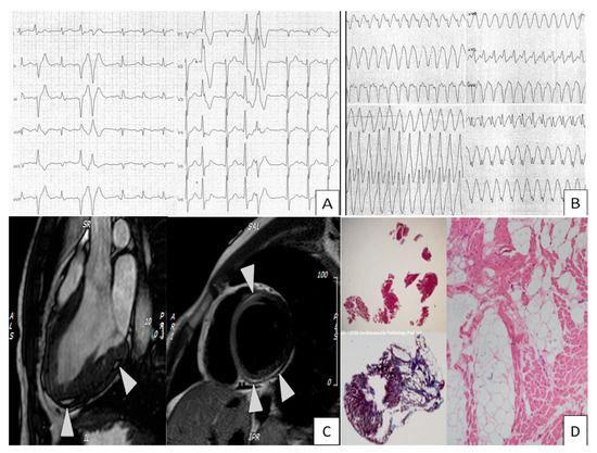 Sudden Cardiac Death in Athletes: From the Basics to the Practical Work-Up