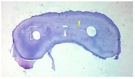 An Update on Endodontic Microsurgery of Mandibular Molars: A Focused Review