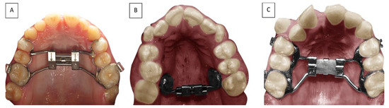 Effectiveness of Dental and Maxillary Transverse Changes in Tooth-Borne ...