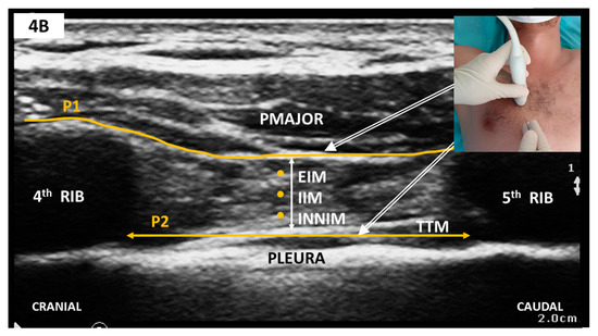 Ultrasound-Guided Regional Anesthesia–Current Strategies for Enhanced ...