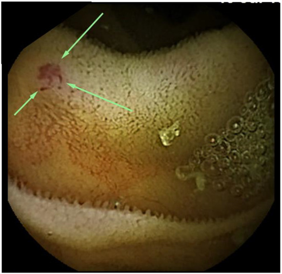 Contribution of Capsule Endoscopy Early in a Bleeding Episode to Treatment of Small Bowel ...
