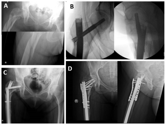 Medial Calcar Comminution and Intramedullary Nail Failure in Unstable ...