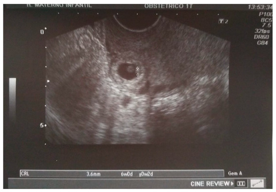 Medicina Free Full Text Cesarean Scar Ectopic Pregnancy—case Series