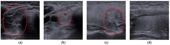 Intelligent Diagnosis of Thyroid Ultrasound Imaging Using an Ensemble ...