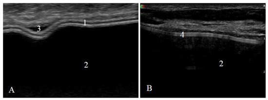 The Value of Ultrasound in the Evaluation of the Integrity of Silicone ...